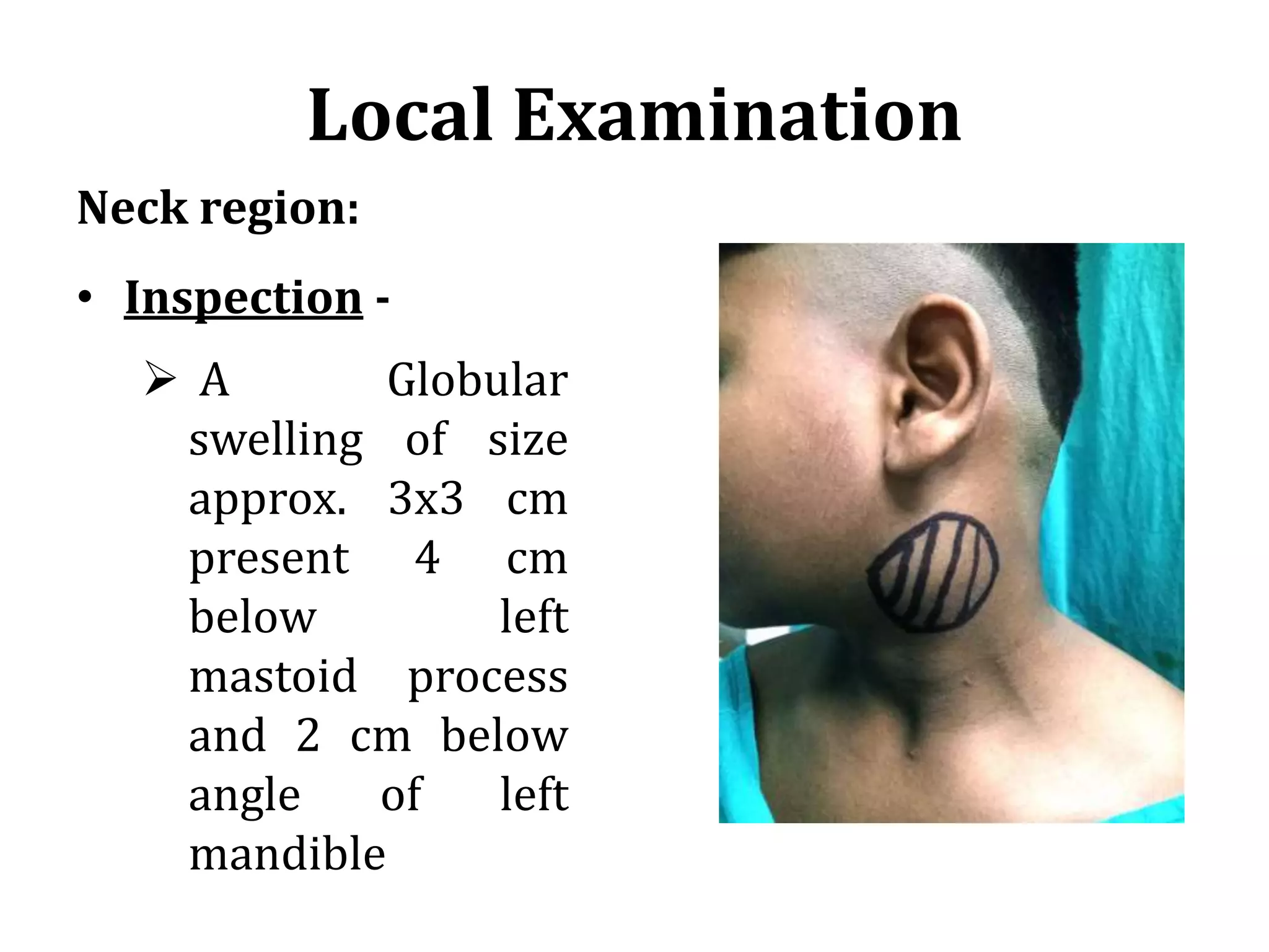 Cervical schwannoma in 12 year boy | PPTX