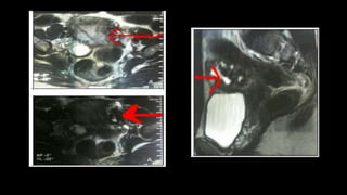 Case Report on Invasive Mole. Gestational Trophoblastic Neoplasia (GTN ...