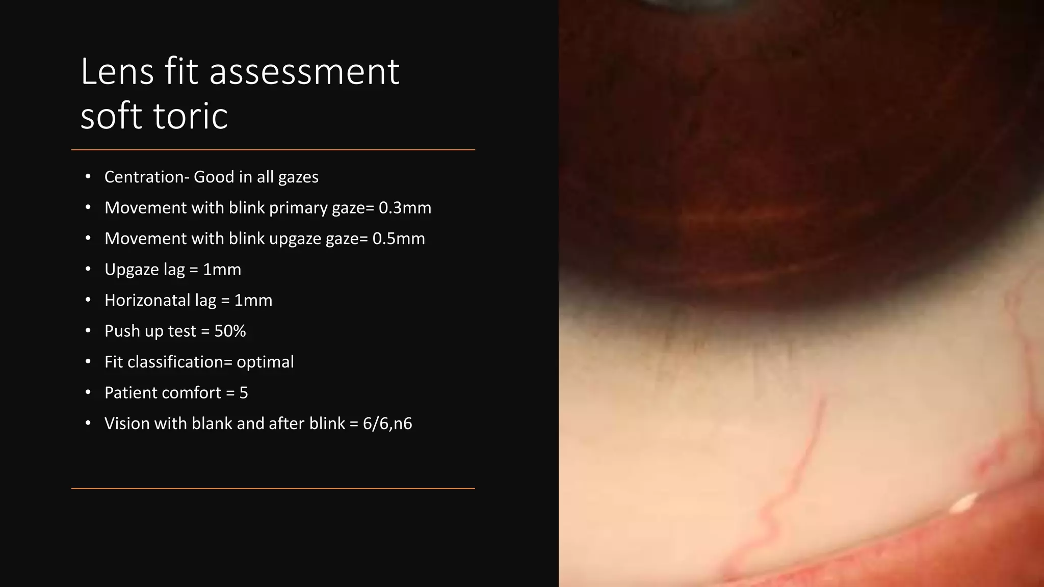 Case report on keratoconus management | PPTX