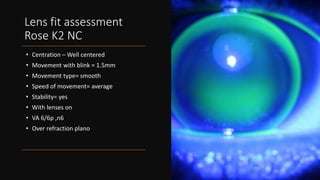 Case report on keratoconus management | PPTX