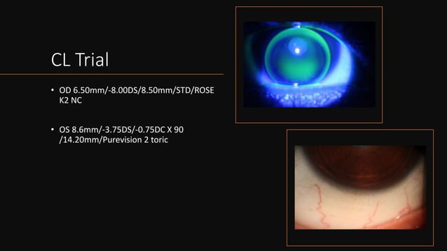 Case report on keratoconus management | PPTX | Eye and Vision ...