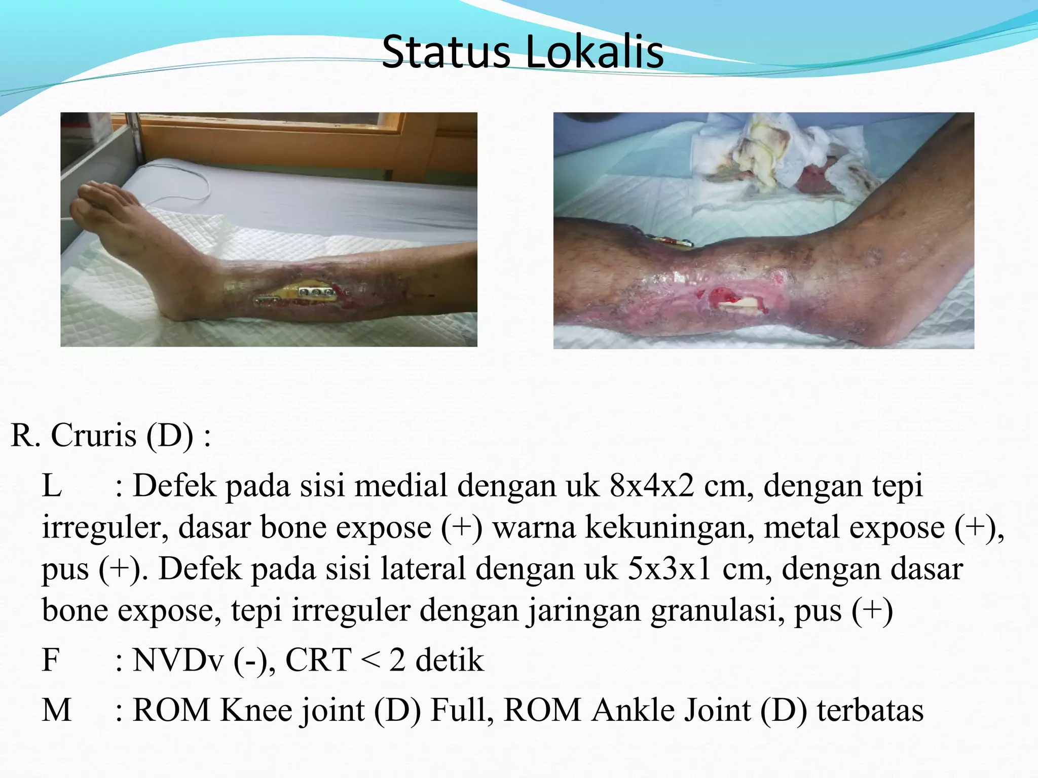 Case Report Tibial Defect Post ORIF | PPT