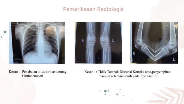 case report JRA | PPTX