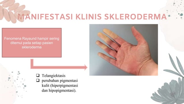 case report JRA | PPTX