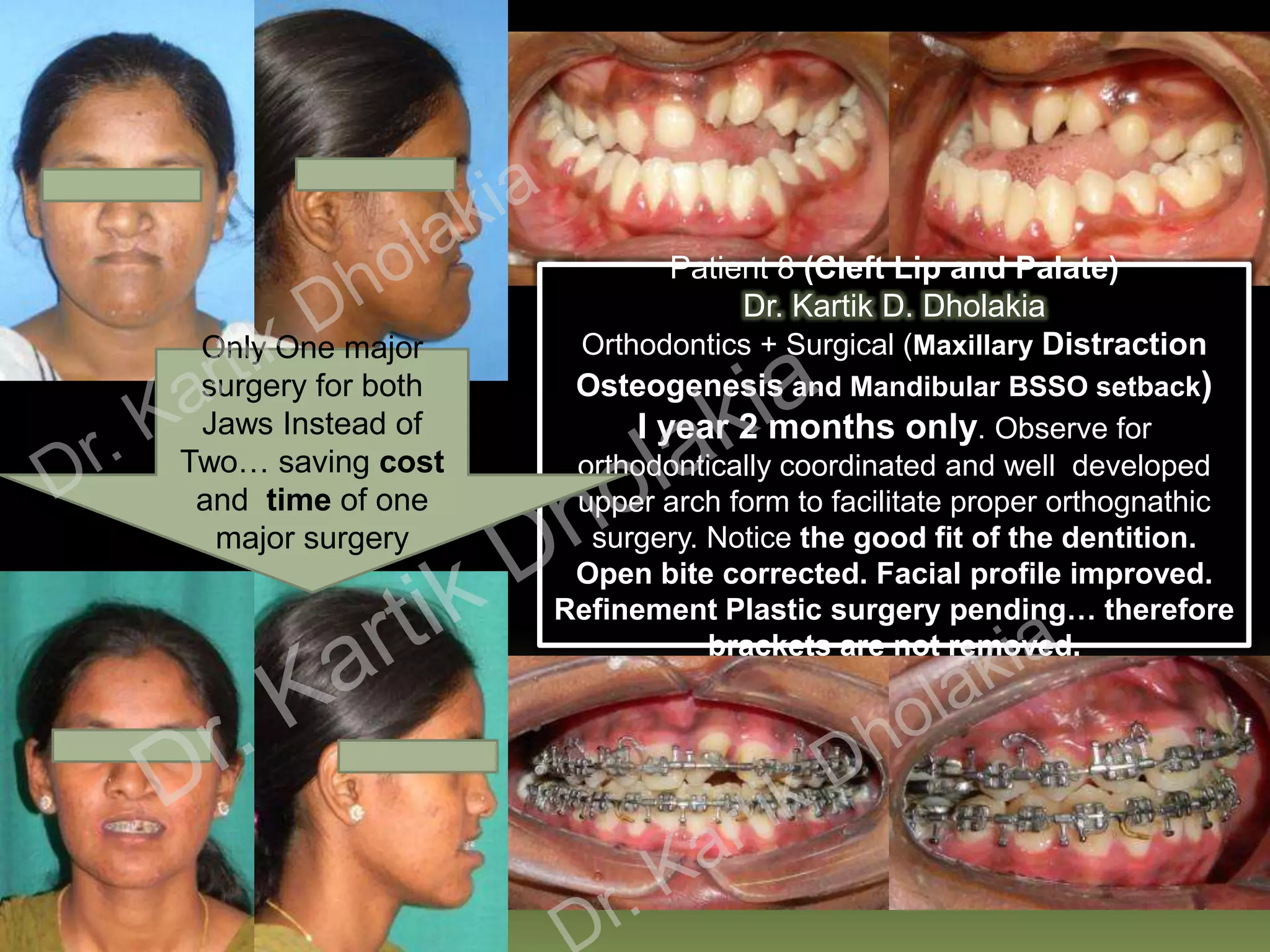 Cases - KD Orthodontics | PPSX