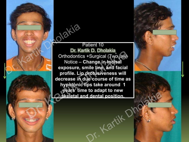 Cases - KD Orthodontics | PPT