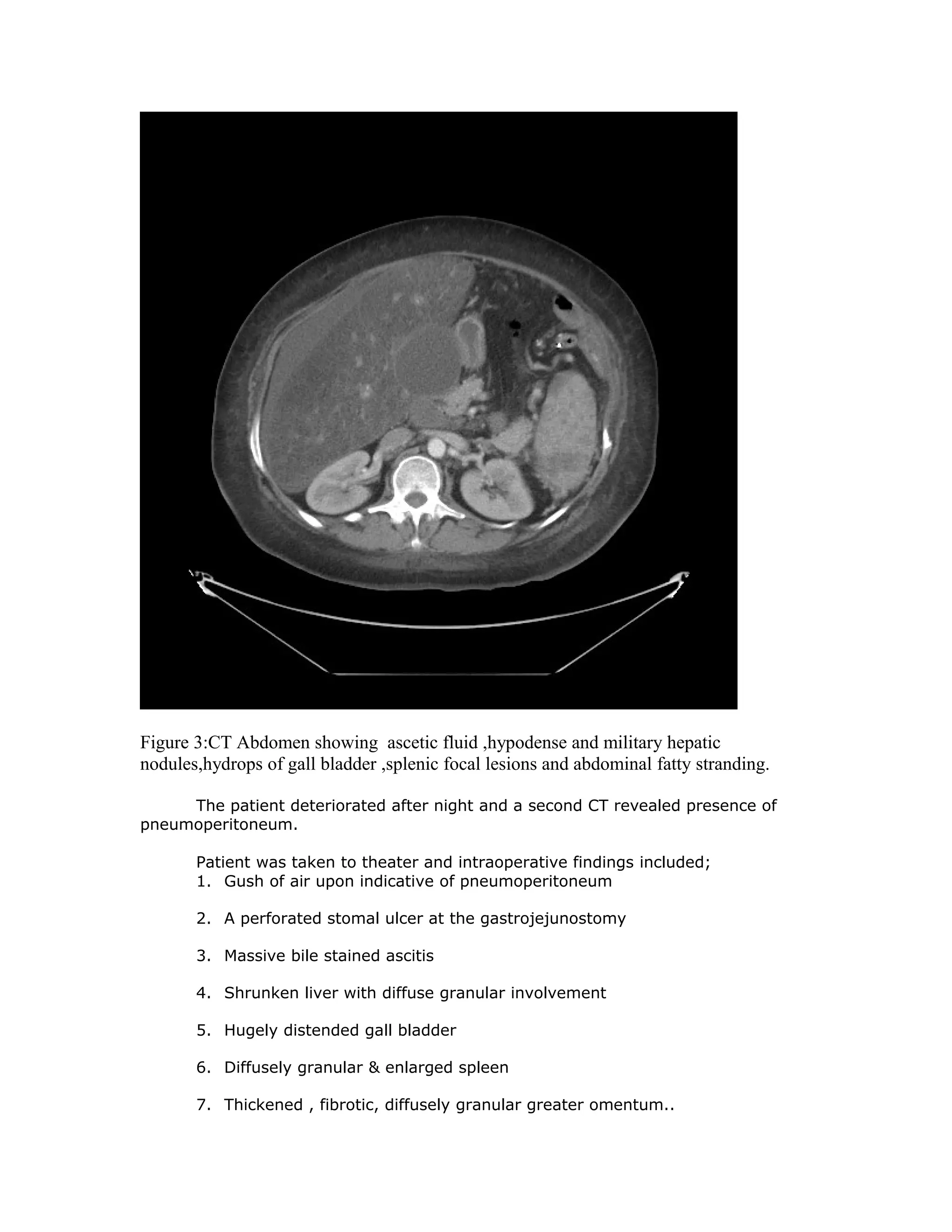 Case report :systemic torulopsis after gastric bypass operation | DOC