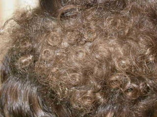 Case report. Wooly hair associated with nevoid hypermelanosis | PPT