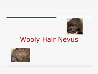 Case report. Wooly hair associated with nevoid hypermelanosis | PPT