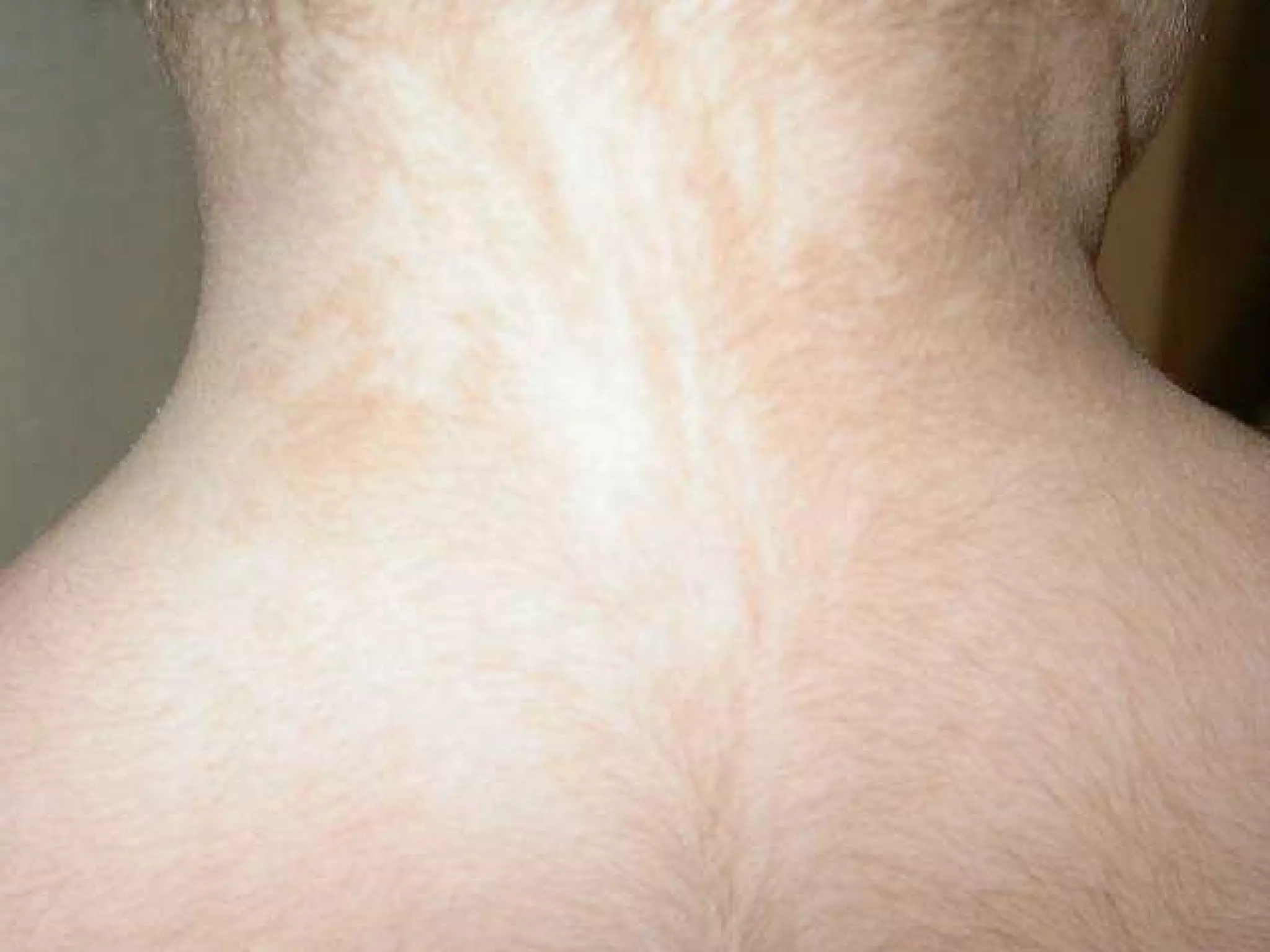 Case report wooly hair | PPT