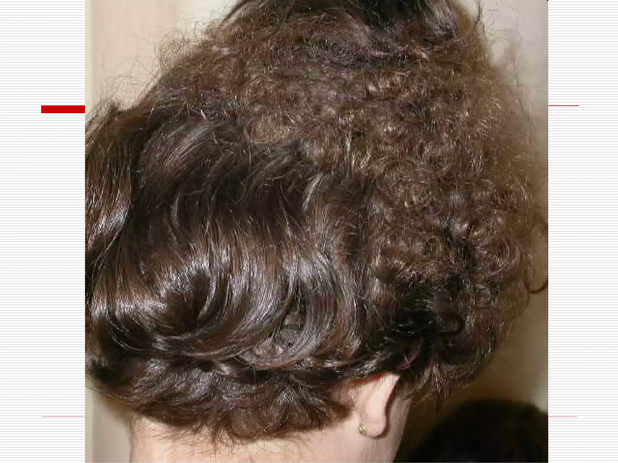 Case report wooly hair | PPT