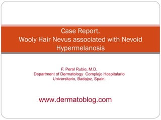wooly hair and nevoid hipermelanosis | PPT