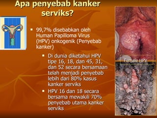 kp Ca serviks | PPT