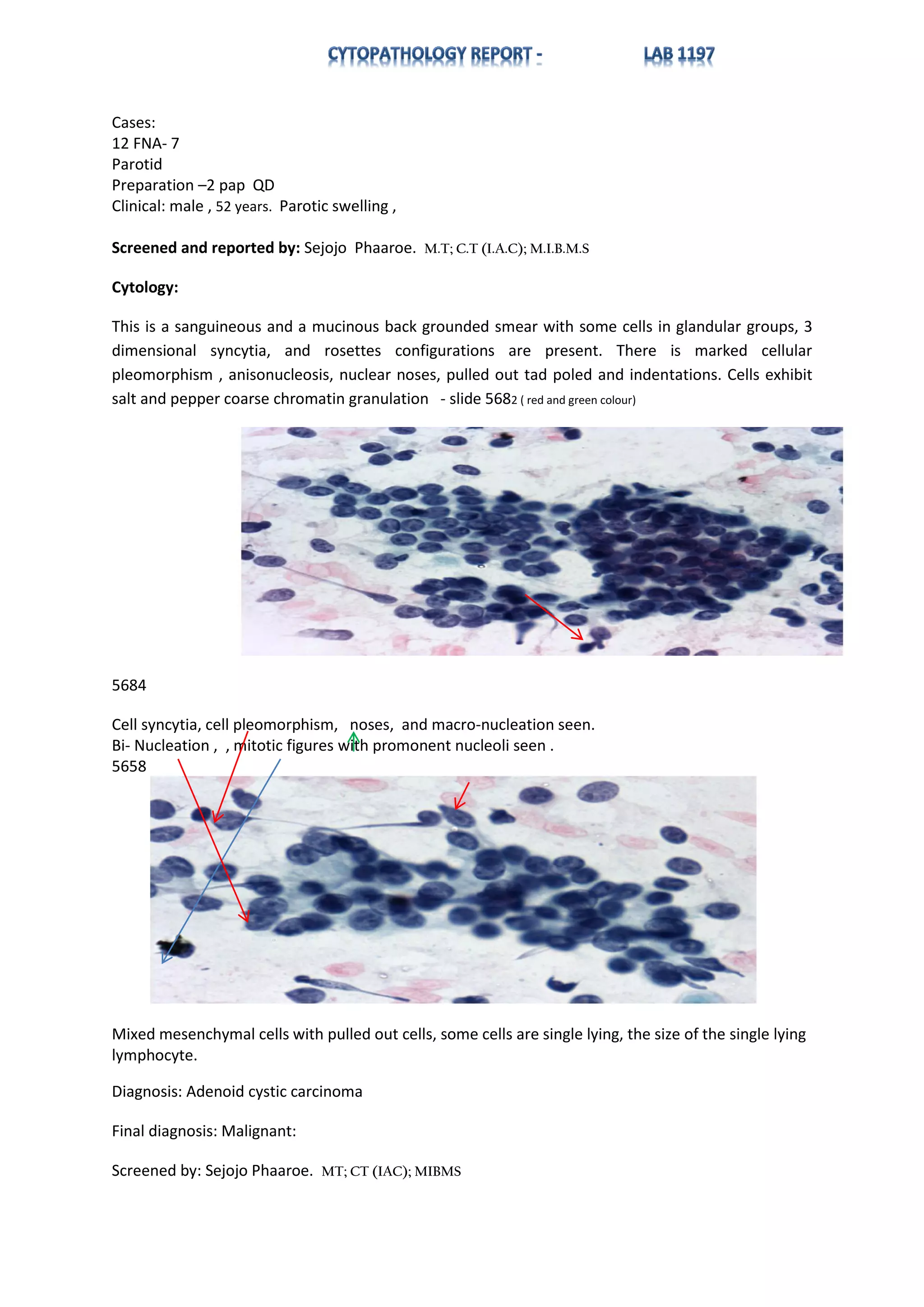 Salivary Gland Cytology case of adenoid cyst carcinoma | PDF