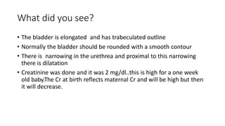 CASE SCENARIO HYDRONEPHROSISdbdtbdtgdtgd.pdf