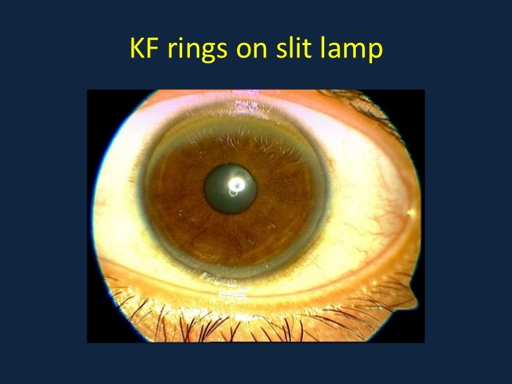 Case scenarios in wilson disease by Dr Aabha Nagral