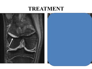Recurrent patellar dislocation case scenario | PPTX
