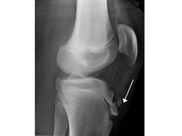 Recurrent patellar dislocation case scenario | PPTX | Death, Injury, or ...