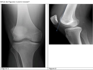 Recurrent patellar dislocation case scenario | PPTX