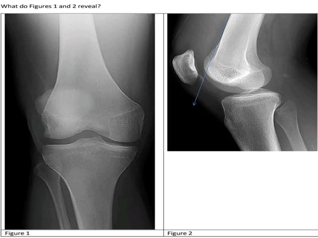 Recurrent patellar dislocation case scenario | PPTX | Death, Injury, or ...
