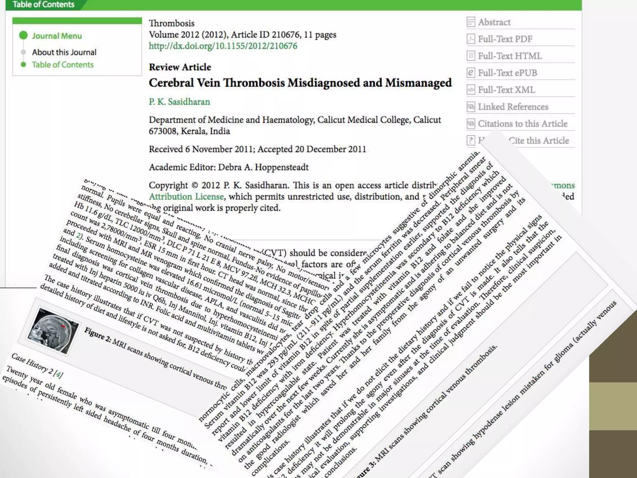 Case series -cerebral venous sinus thrombosis - Dr Shaz Pamangadan | PPTX