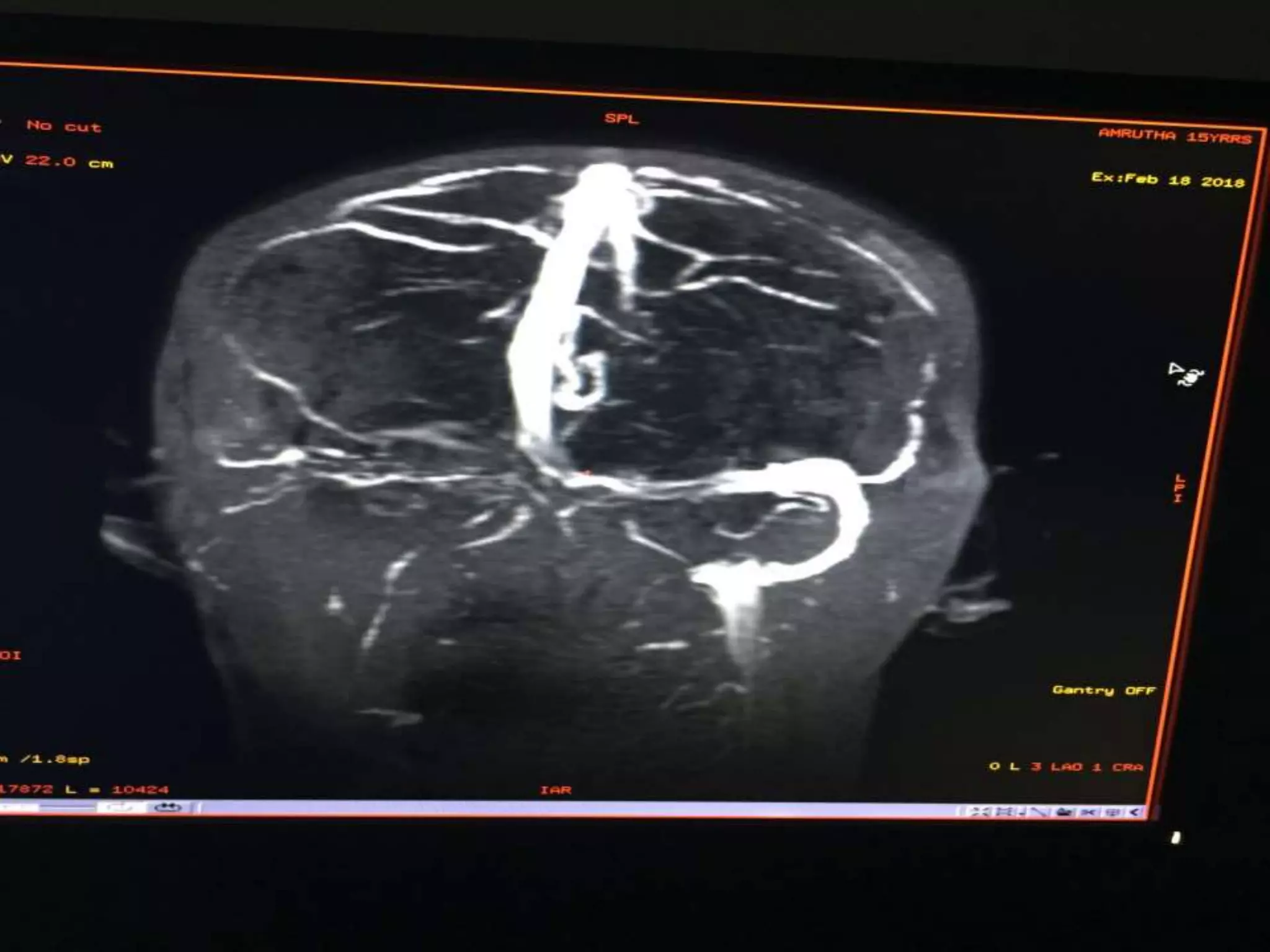 Case series -cerebral venous sinus thrombosis - Dr Shaz Pamangadan | PPTX