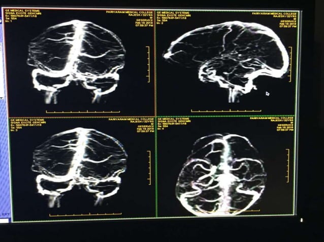 Case series -cerebral venous sinus thrombosis - Dr Shaz Pamangadan | PPT