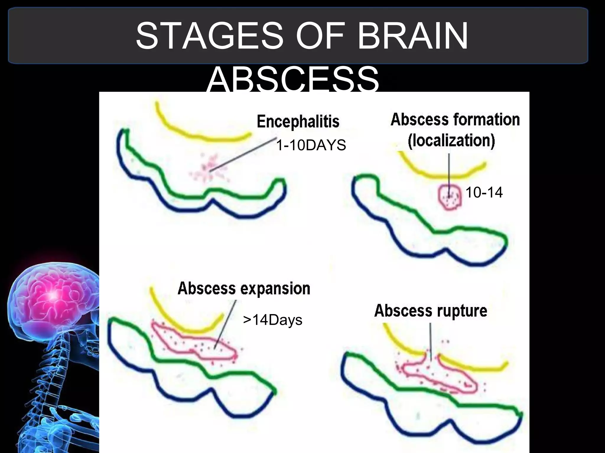Case series otogenic brain abcess | PPT