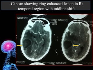 Case series otogenic brain abcess | PPT