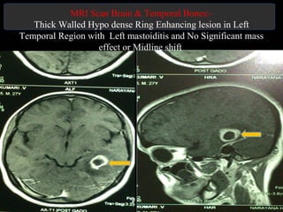 Case series otogenic brain abcess | PPT