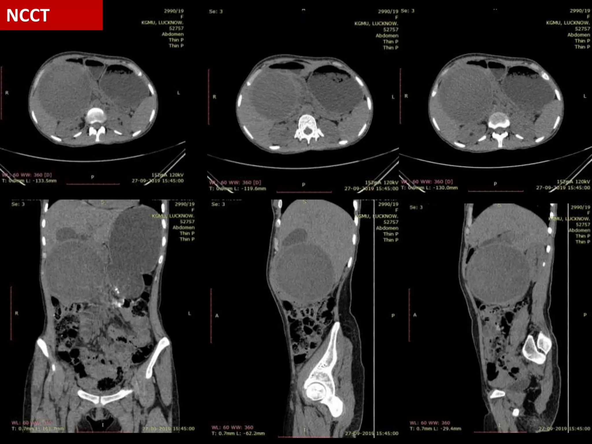 Spen Pancrease Case Pptx 8218