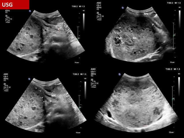 Spen Pancrease Case Pptx 4952