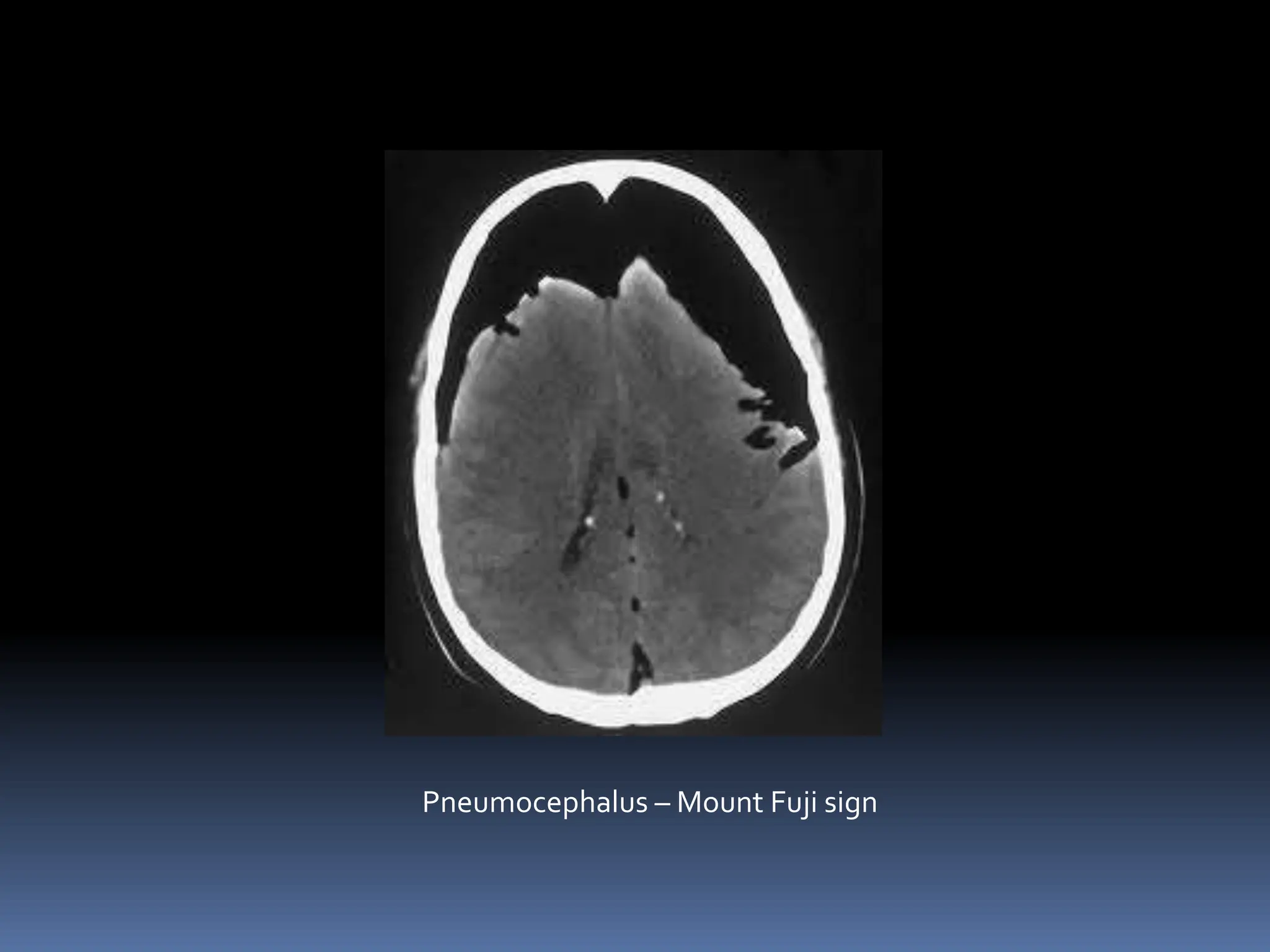 Case Studies - Brain CT scan explained.pptx