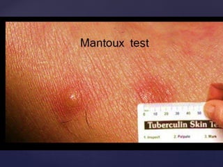 Case studies to assess the efficiency of mantoux test | PPT