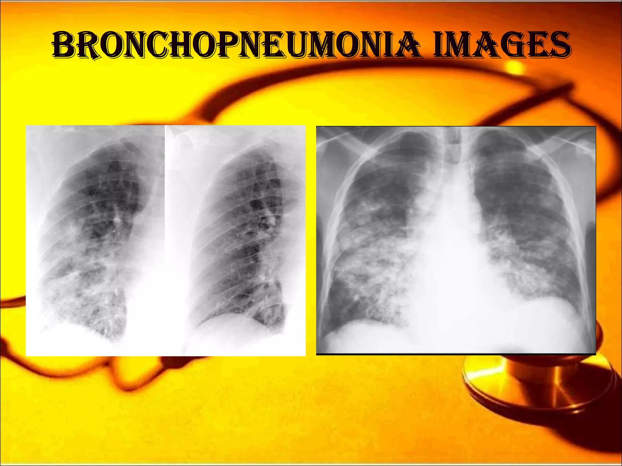 Case study BronchoPneumonia | PPT