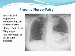 Case Study: Diaphragm Eventration with differtials | PPTX