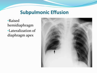 Case Study: Diaphragm Eventration with differtials | PPTX