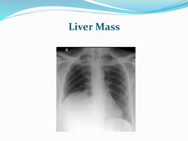Case Study: Diaphragm Eventration with differtials | PPTX | Lung and ...
