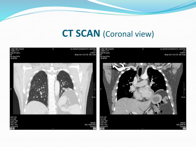 Case Study: Diaphragm Eventration with differtials | PPTX | Lung and ...
