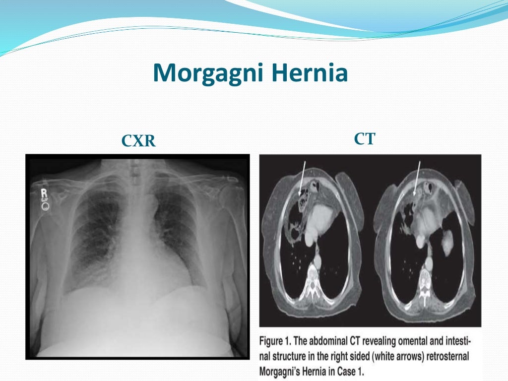 Case Study: Diaphragm Eventration with differtials