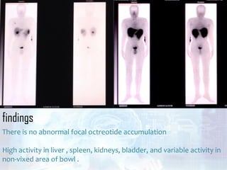Octreotide Case study | PDF