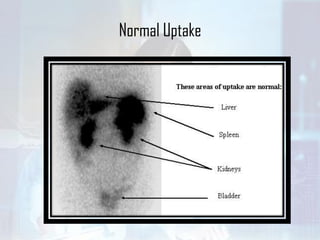 Octreotide Case study | PDF