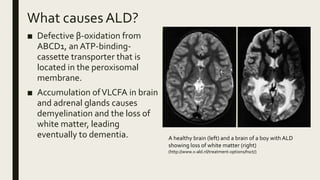 ALD Case study | PPTX