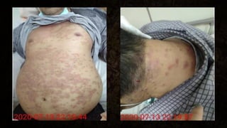 Case Study of syphilis in patient comes to | PPTX