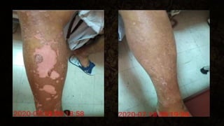 Case Study of syphilis in patient comes to | PPTX