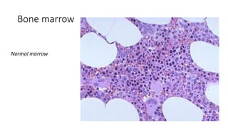 Case Study - Aplastic Anemia | PPTX