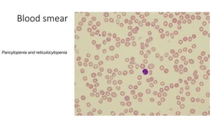 Case Study - Aplastic Anemia | PPT