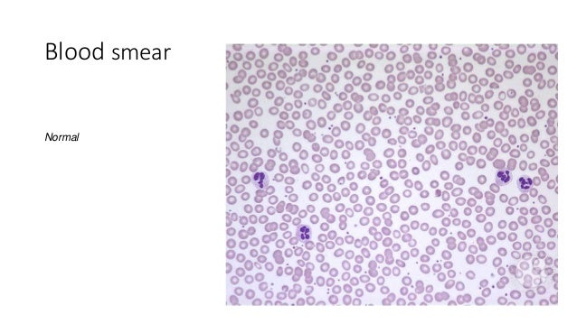 Case Study - Aplastic Anemia