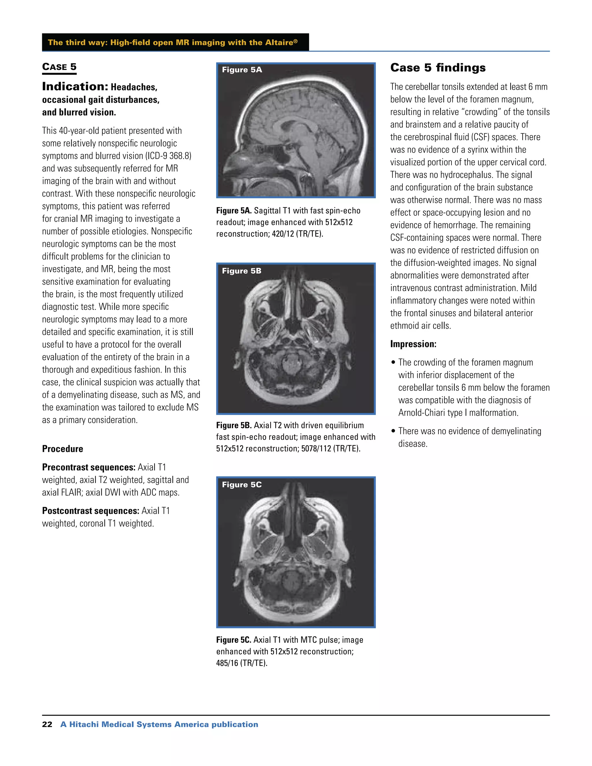 Case Study: Diagnostic Neuroradiology with the Altaire High Field OPEN MRI | PDF