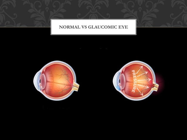 Case study- Glaucoma | PPTX